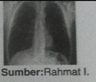 Perhatikan hasil foto rontgen di samping! Pernyata...