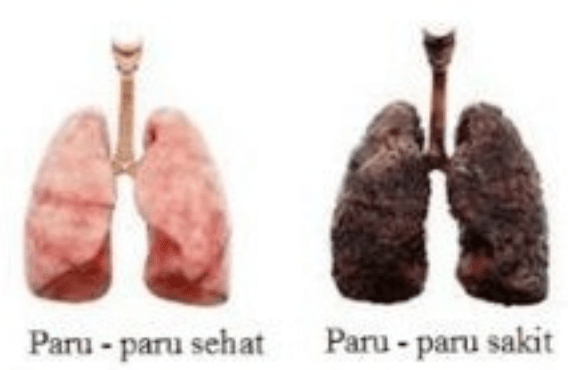 Perhatikan gambar berikut ini! Paru-paru sehat p...